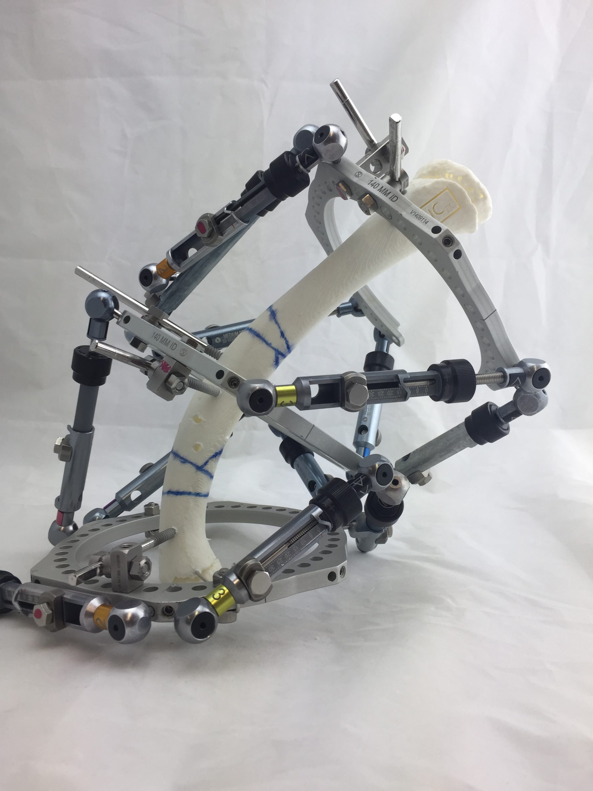 Wessex Children's Orthopaedics - Limb deformity and limb lengthening