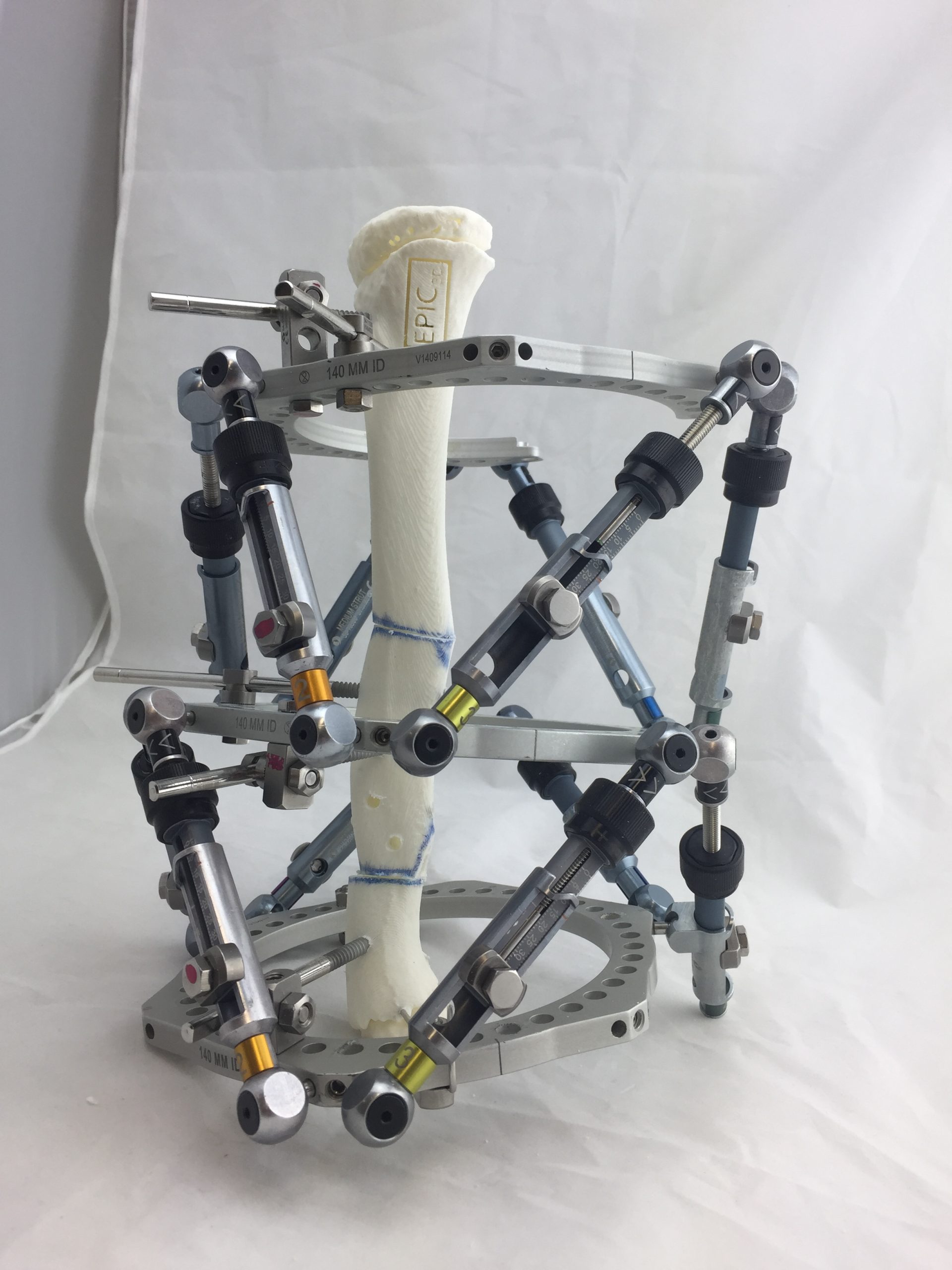 Wessex Children's Orthopaedics - Limb deformity and limb lengthening